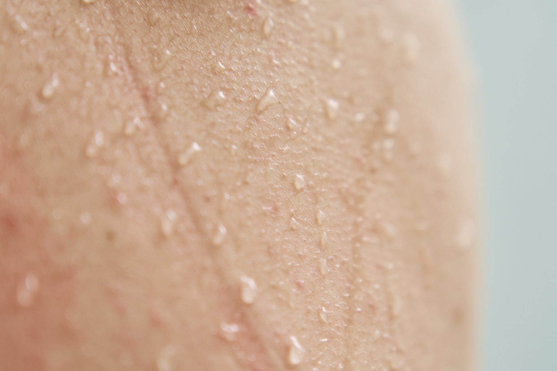 Hyperhidrosis Treatment | Total Skin Dermatology and Aesthetics