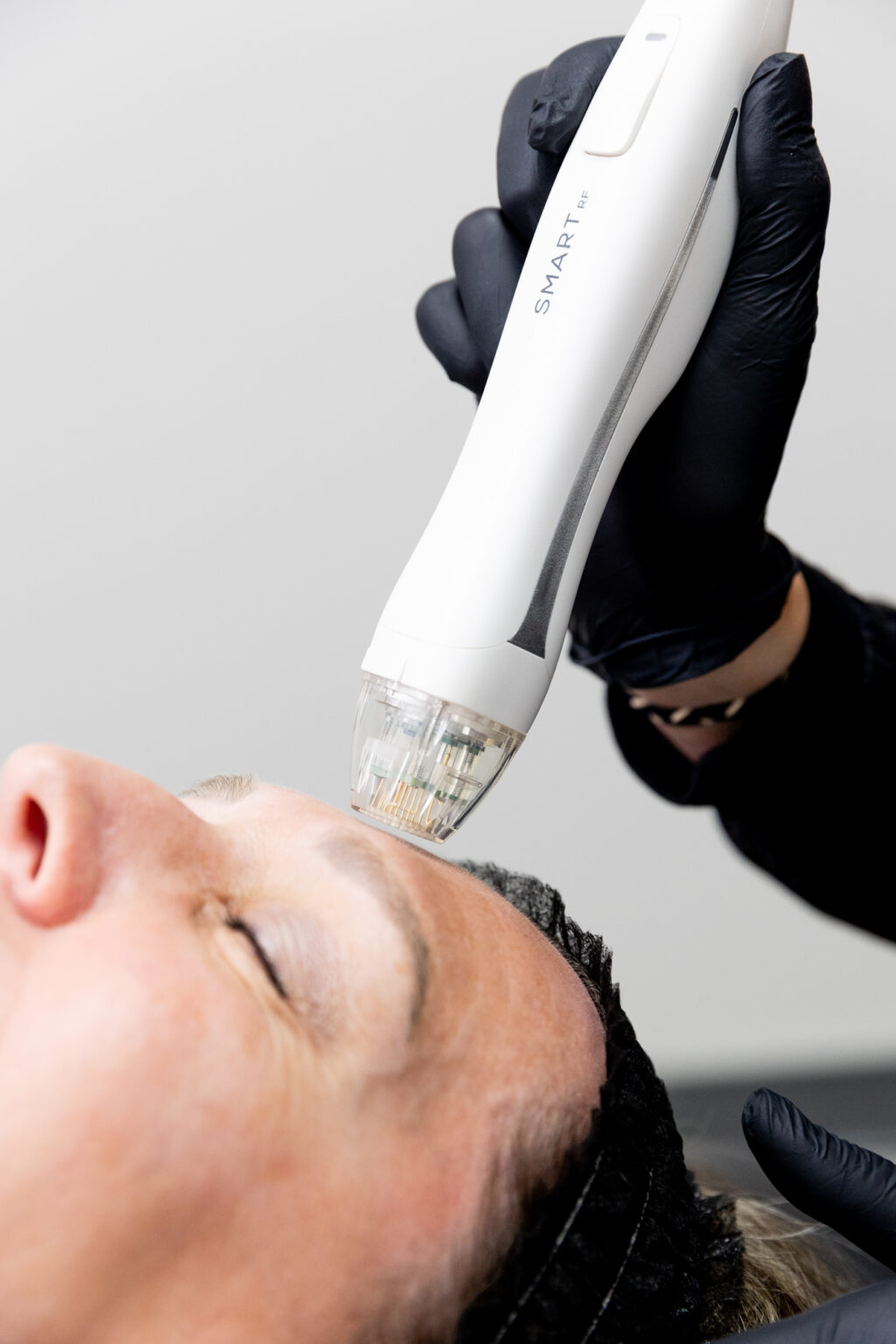 Chemical Peel | Total Skin Dermatology and Aesthetics