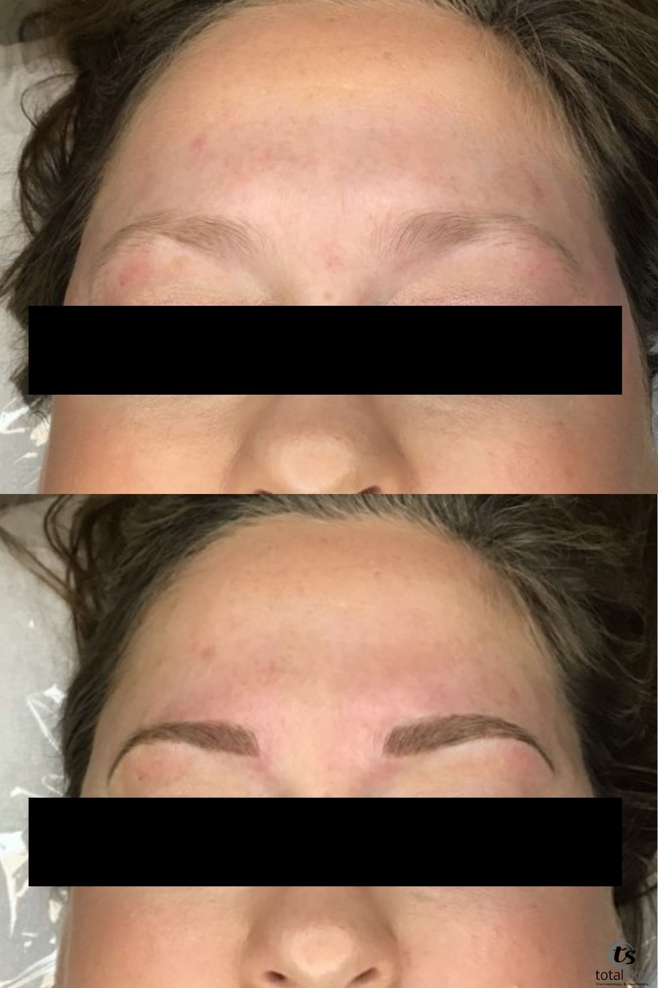 Microblading 2 - Total Skin Dermatology & Aesthetics