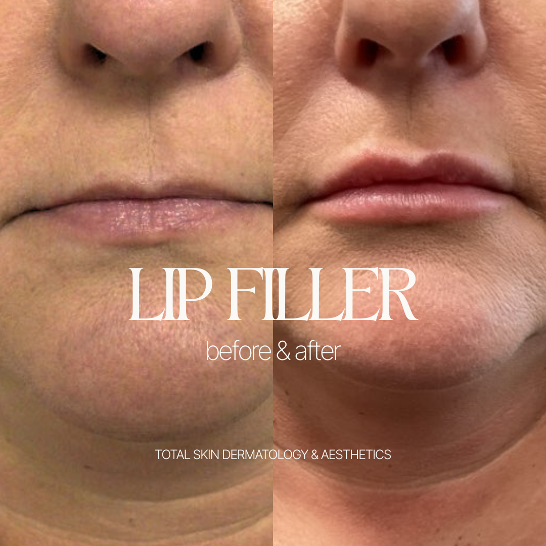 Lip Filler - Total Skin Dermatology & Aesthetics